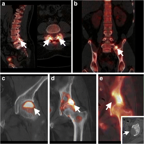 The role of hybrid bone SPECT/CT imaging in the work-up of the limping ...