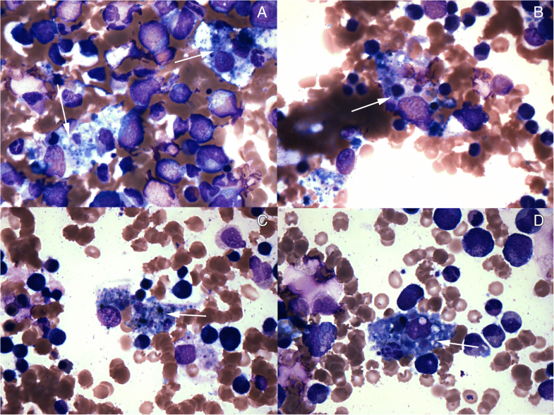 Severe skin disease in lupus associated with hemophagocytic ...