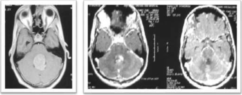 Telovelar approach versus transvermian approach in management of fourth ...