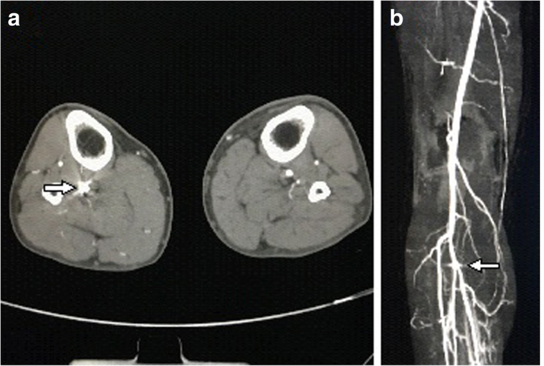 Successful surgical retrieval of Celt ACD® vascular closure device ...