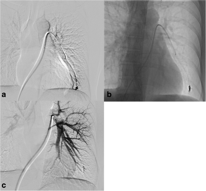 Preliminary experience with the micro vascular plug for the treatment ...