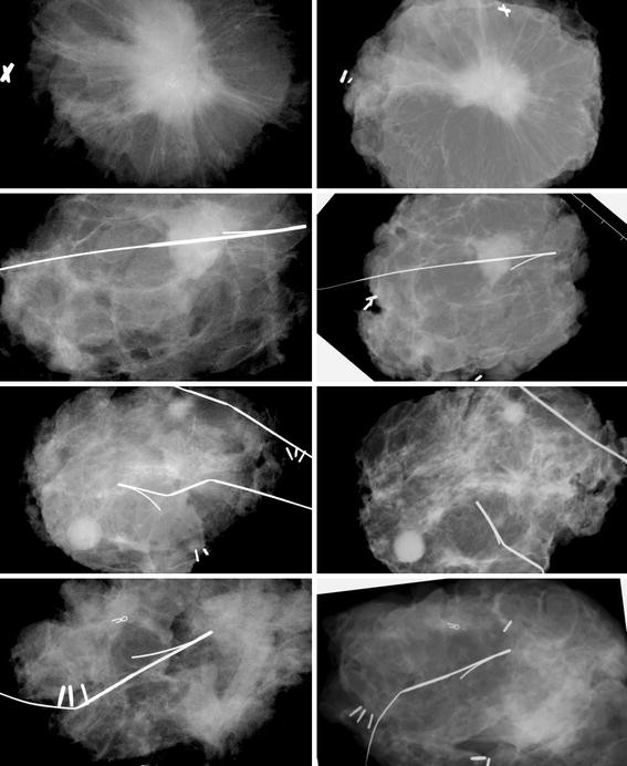 Intraoperative Digital Specimen Mammography: Rapid, Accurate Results ...