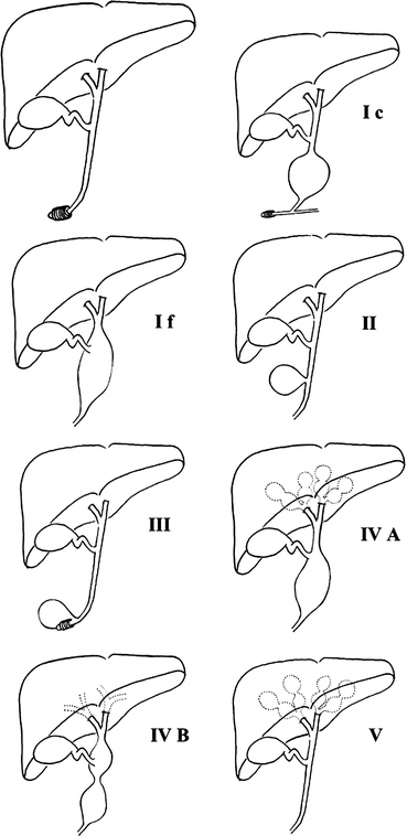 Bile Duct Cyst as Precursor to Biliary Tract Cancer | SpringerLink