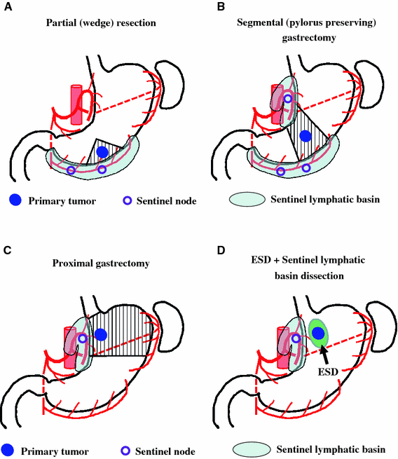 New Sentinel Node Mapping Technologies for Early Gastric Cancer ...