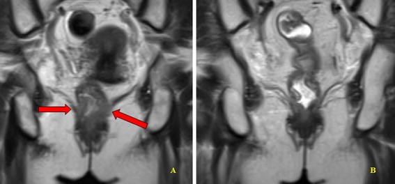 Laparoscopic Extralevator Abdominoperineal Resection for Rectal ...