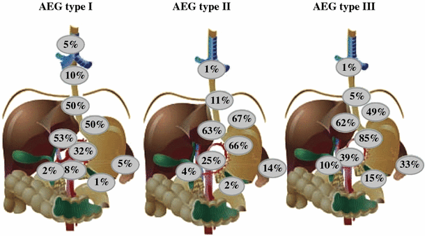 What’s the Best Way to Treat GE Junction Tumors? Approach Like Gastric ...