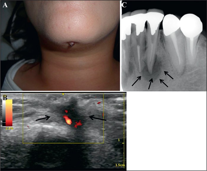 Usefulness of ultrasonography for rapidly diagnosing cutaneous sinus ...