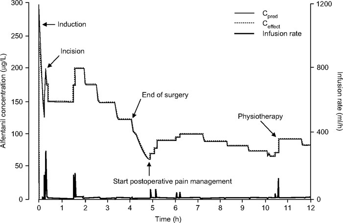 Target-Controlled Infusion Systems | SpringerLink