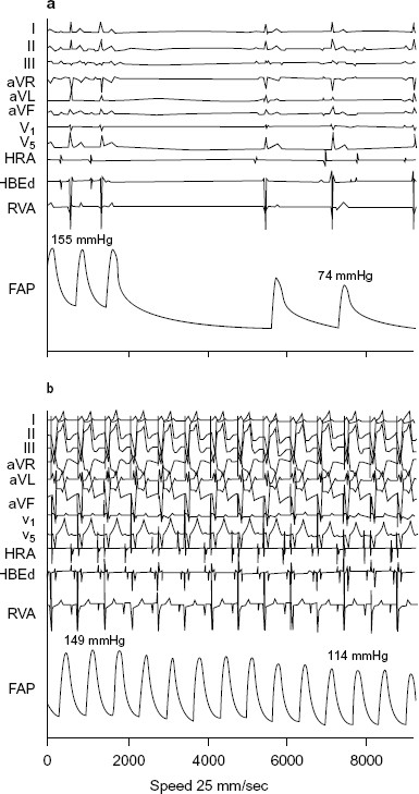 Neurocardiogenic Syncope | SpringerLink