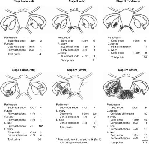 Endometriosis | SpringerLink