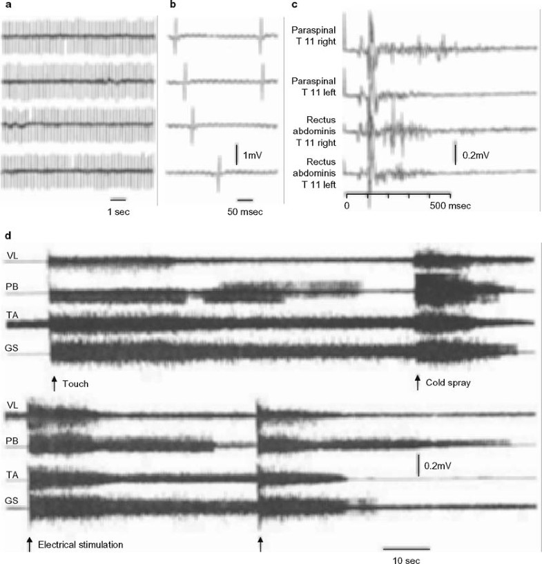 Stiff Man Syndrome | SpringerLink