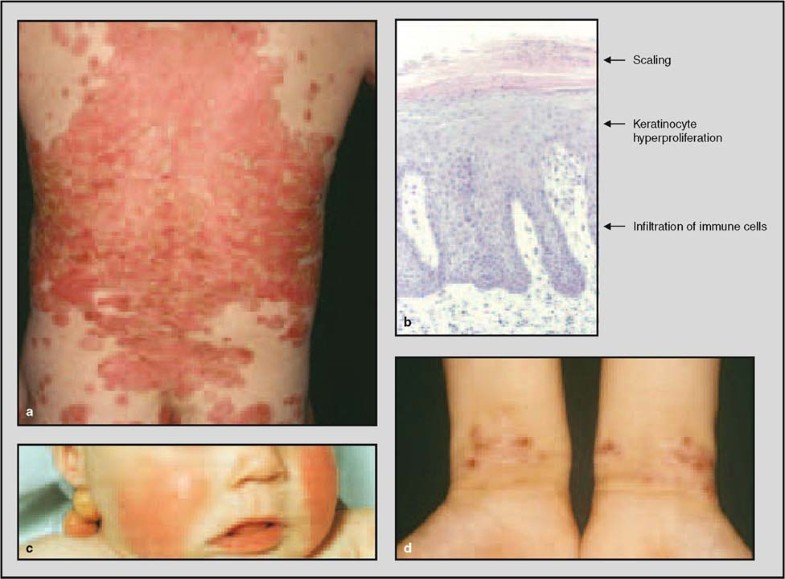 Cytokine and Anti-Cytokine Therapies for Psoriasis and Atopic ...