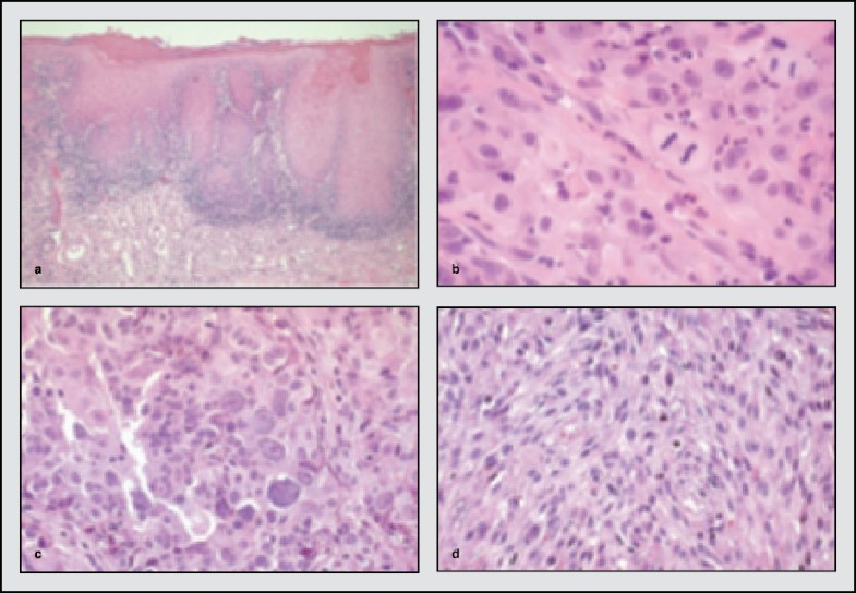 Oral Cancer | SpringerLink
