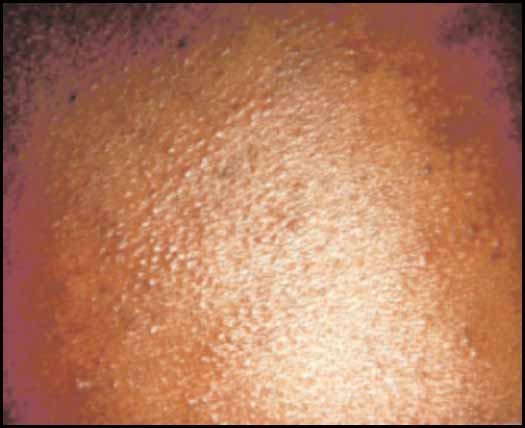 Cutaneous Tuberculosis | SpringerLink