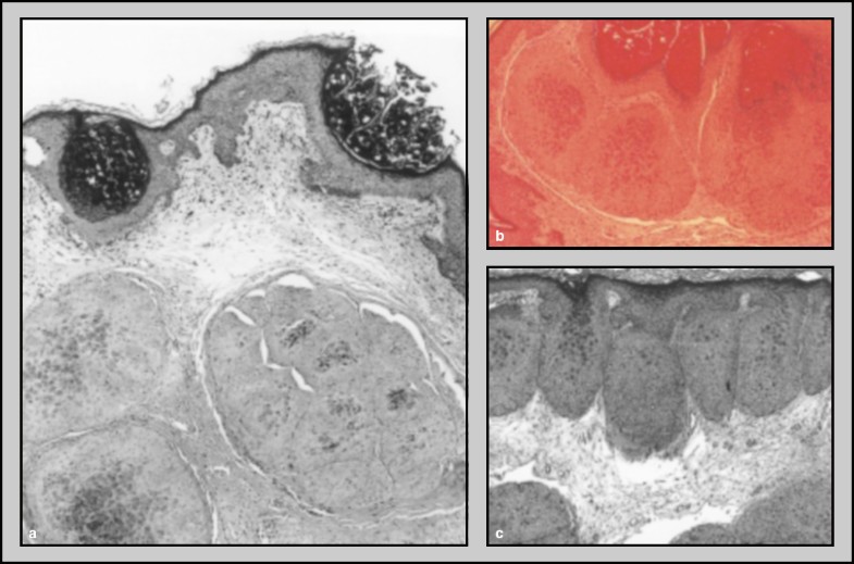 Molluscum Contagiosum | SpringerLink
