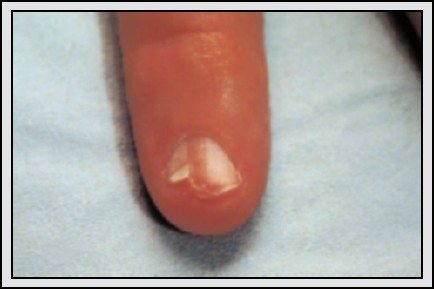 Darier’s Disease | SpringerLink