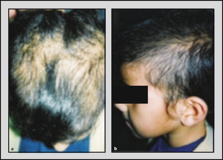 Monilethrix | SpringerLink