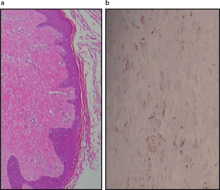 Association of Psoriasis and Vulval Fibroepithelial Polyp | SpringerLink