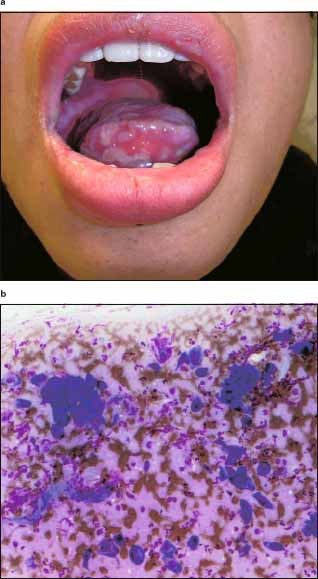 Reintroducing the Tzanck Smear | SpringerLink