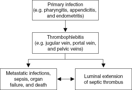 Septic Thrombophlebitis | SpringerLink