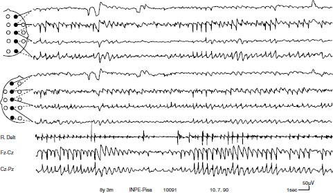 Angelman Syndrome | SpringerLink