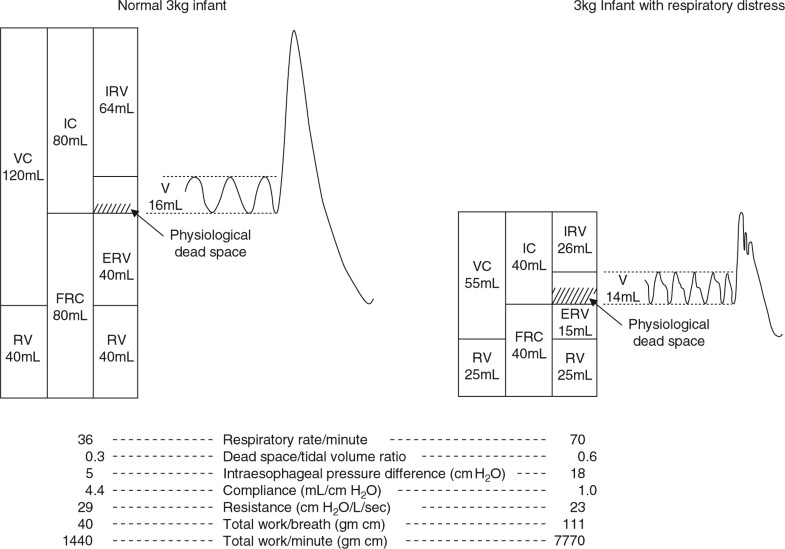 Pathophysiology of Neonatal Respiratory Distress Syndrome | SpringerLink