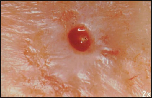 Recognition and Management of Common Ectoparasitic Diseases in ...