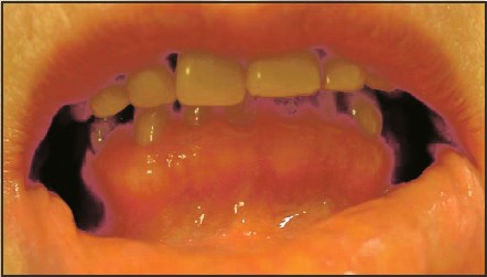 Absence of Inferior Labial and Lingual Frenula in Ehlers-Danlos ...