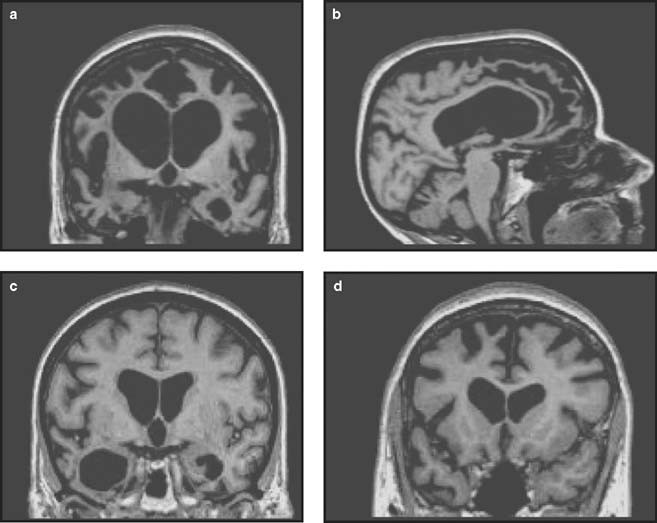 Frontotemporal lobar degeneration | SpringerLink