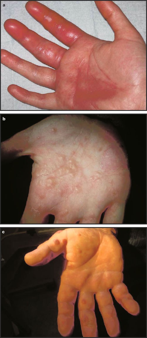 Pompholyx | SpringerLink