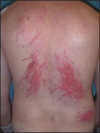 Flagellate Dermatitis as a Bleomycin-Specific Adverse Effect of ...