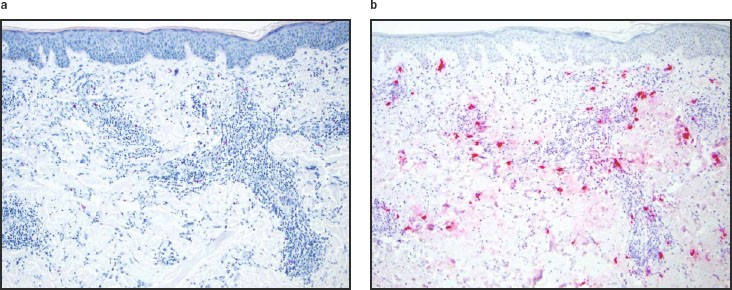 Flagellate Dermatitis as a Bleomycin-Specific Adverse Effect of ...