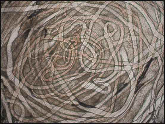 Eruptive Vellus Hair Cysts | SpringerLink