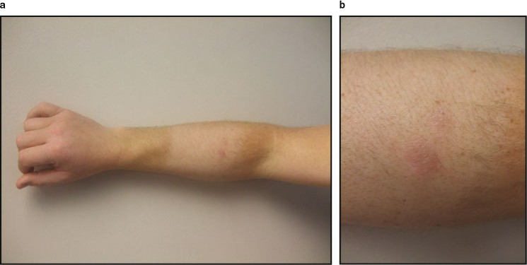 Paraneoplastic Erythema Annulare Centrifugum Eruption: PEACE | SpringerLink