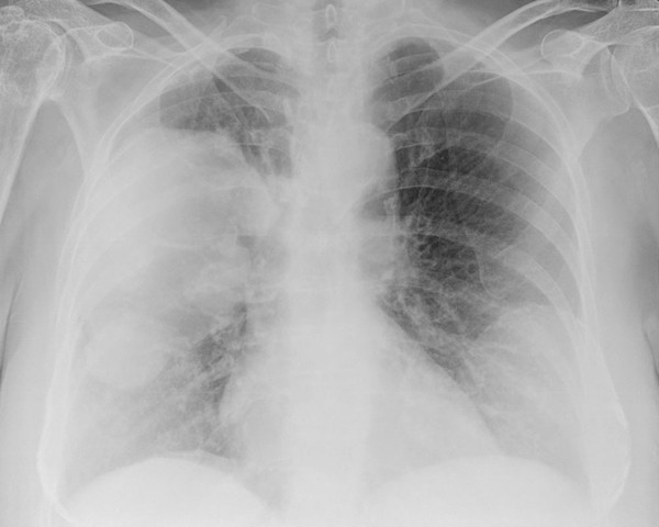Primary pulmonary mucinous cystadenocarcinoma presenting as a complex ...