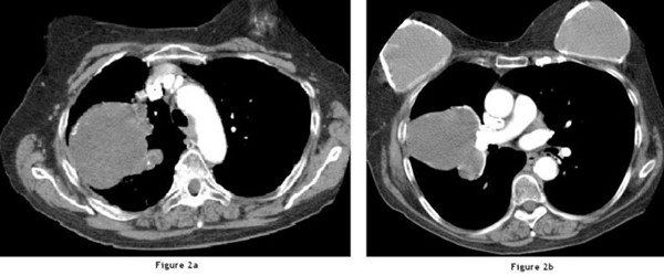 Primary pulmonary mucinous cystadenocarcinoma presenting as a complex ...
