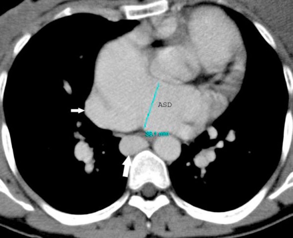Interrupted inferior vena cava and partial anomalous pulmonary venous ...