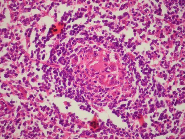 A multicentric, hyaline vascular variant of Castleman's disease ...