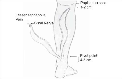 S-shaped reverse sural flap for reconstruction of tissue defect on heel ...