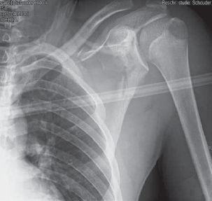 De floating shoulder | SpringerLink