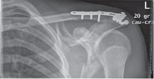 De floating shoulder | SpringerLink