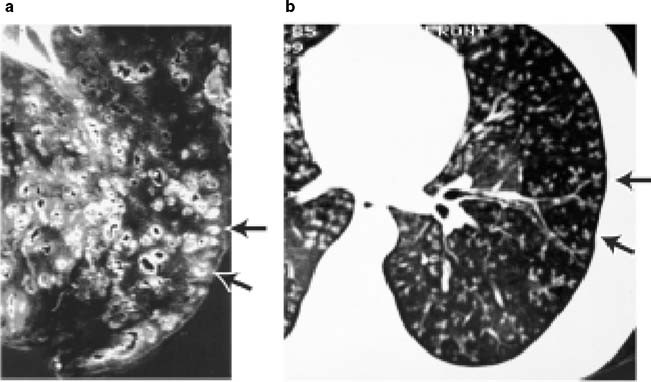 Diffuse Panbronchiolitis | SpringerLink