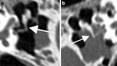Correlation of CT and Histopathology in Resorption of the Distal Long ...
