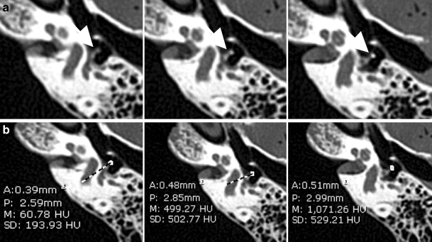 Correlation of CT and Histopathology in Resorption of the Distal Long ...