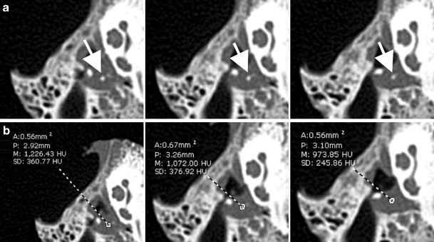 Correlation of CT and Histopathology in Resorption of the Distal Long ...