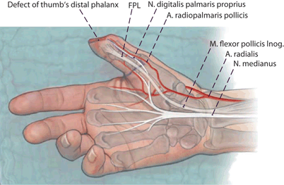 Reconstruction of the thumb tip using palmar neurovascular flaps ...