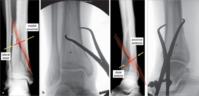 Minimal-invasive Plattenosteosynthese am distalen Tibiaschaft ...