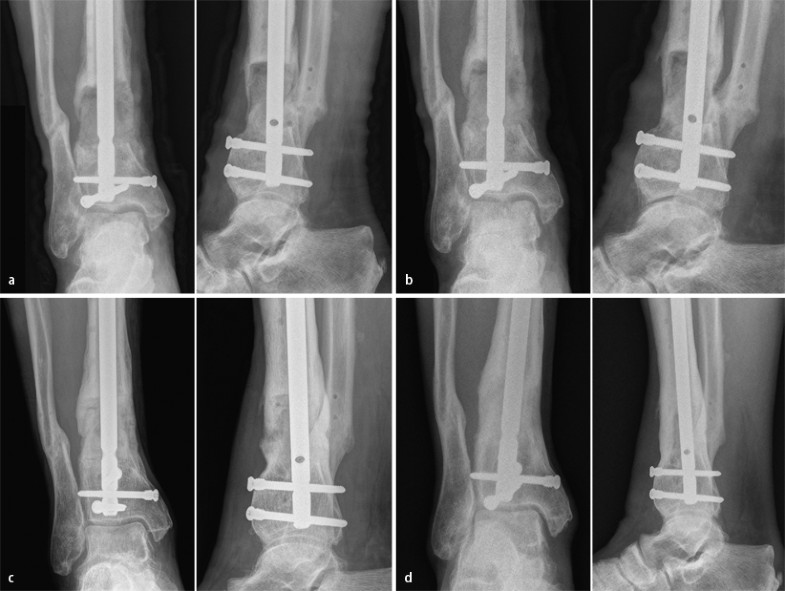 Die Masquelet-Technik zur Behandlung großer dia- und metaphysärer ...