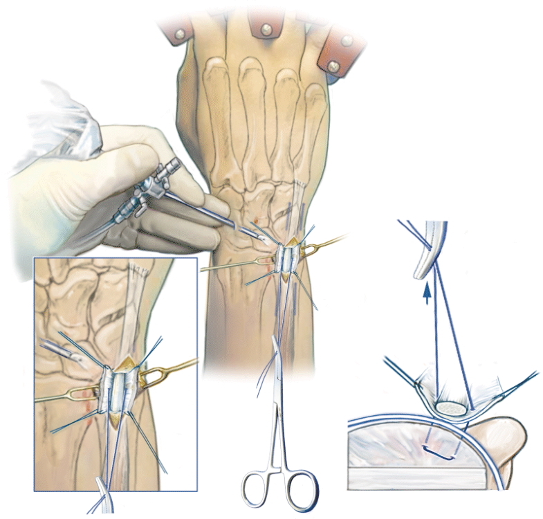 Die arthroskopisch unterstützte transkapsuläre Refixation des Discus ...