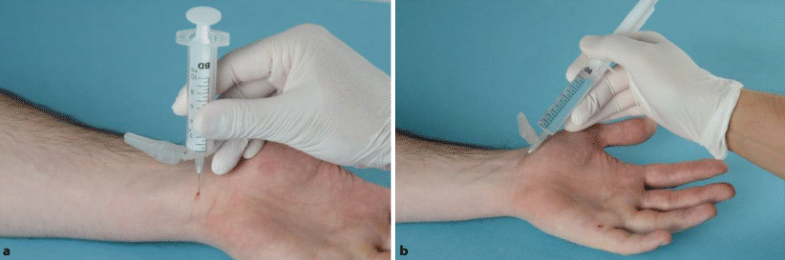 Wide-awake-Technik in der Handchirurgie anhand von Anwendungsbeispielen ...